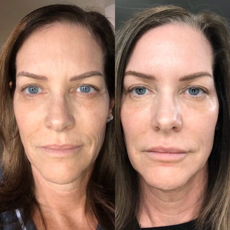 Active FX Laser Skin Resurfacing | Derma Health