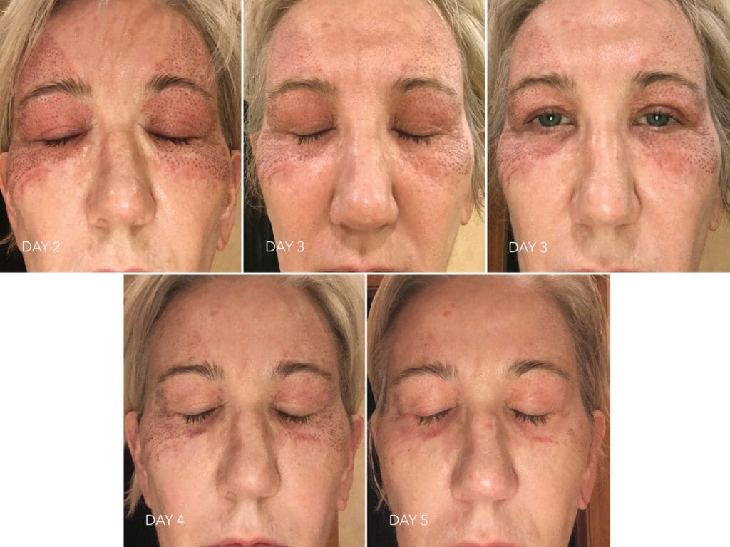 Plasma Pen | Derma Health