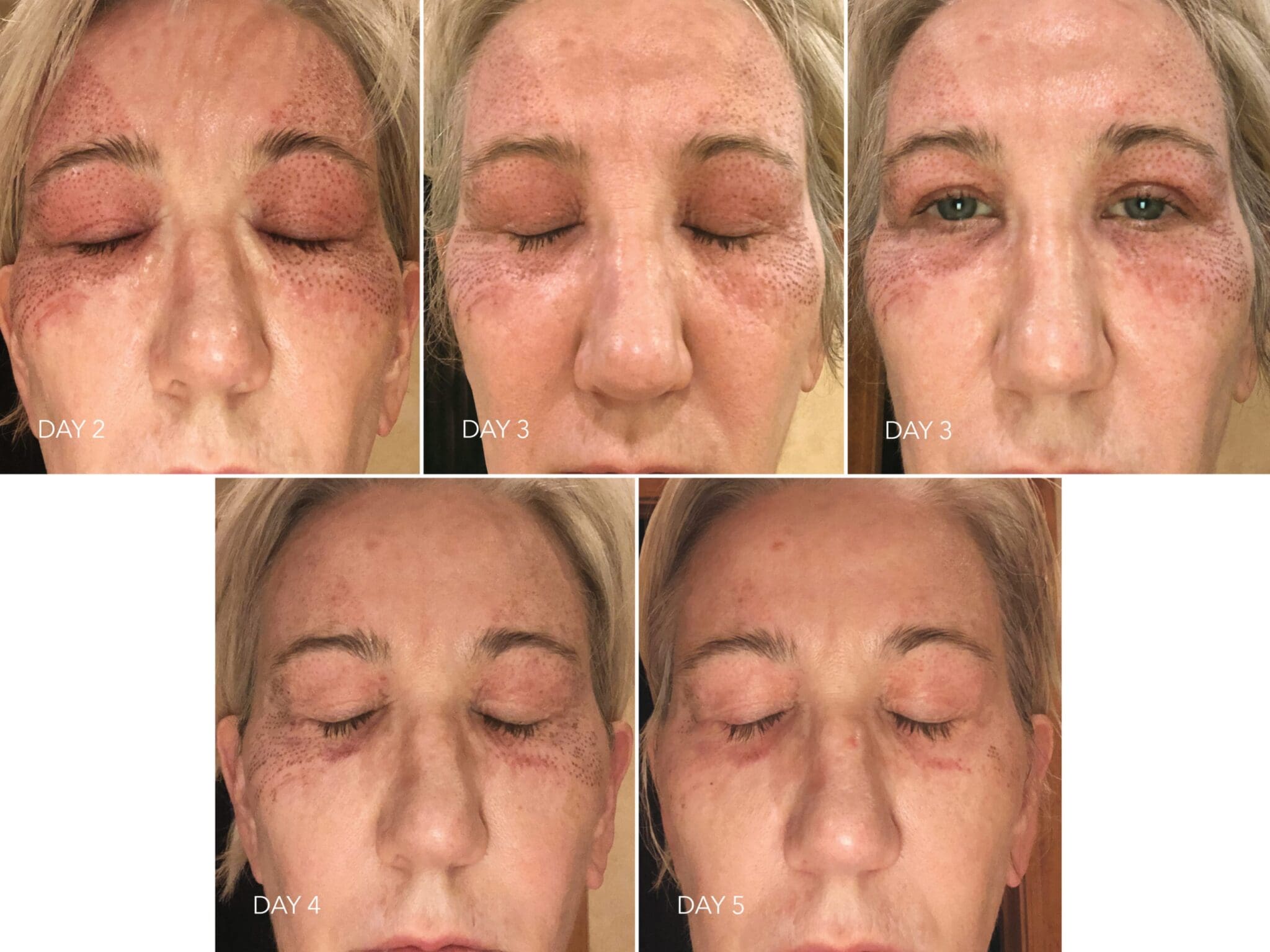 Plasma Pen | Derma Health