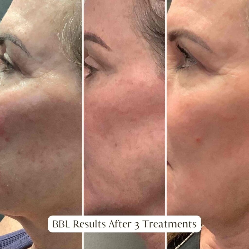 Broadband Light | Derma Health